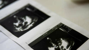 Cortesía | Cada bebé tiene su propia matriz y placenta separados
